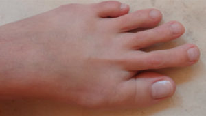 Jak palec młotkowaty uderza w sprawność stopy?